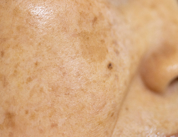 Dark Spots On Face Uk